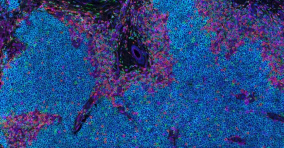 New guide helps clinicians navigate immunotherapy revolution in Merkel ...