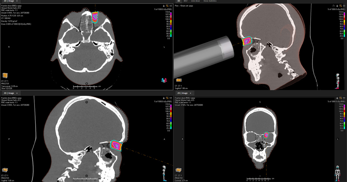 The Beam: PBS for ocular cancers; prostate cancer support group; meet ...