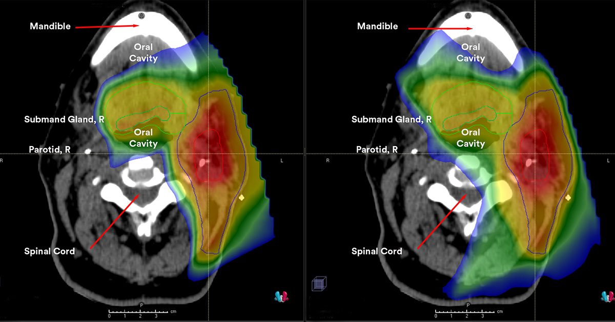 The Beam: Protons for head and neck cancers, a look at our RTTs, meet ...