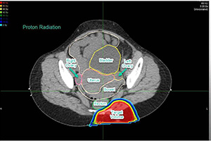 Sarcoma | Fred Hutchinson Cancer Center