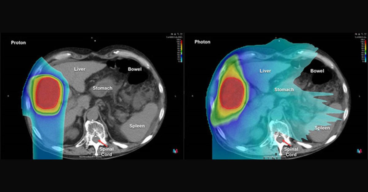 The Beam: Understanding liver, gastrointestinal and breast cancer ...