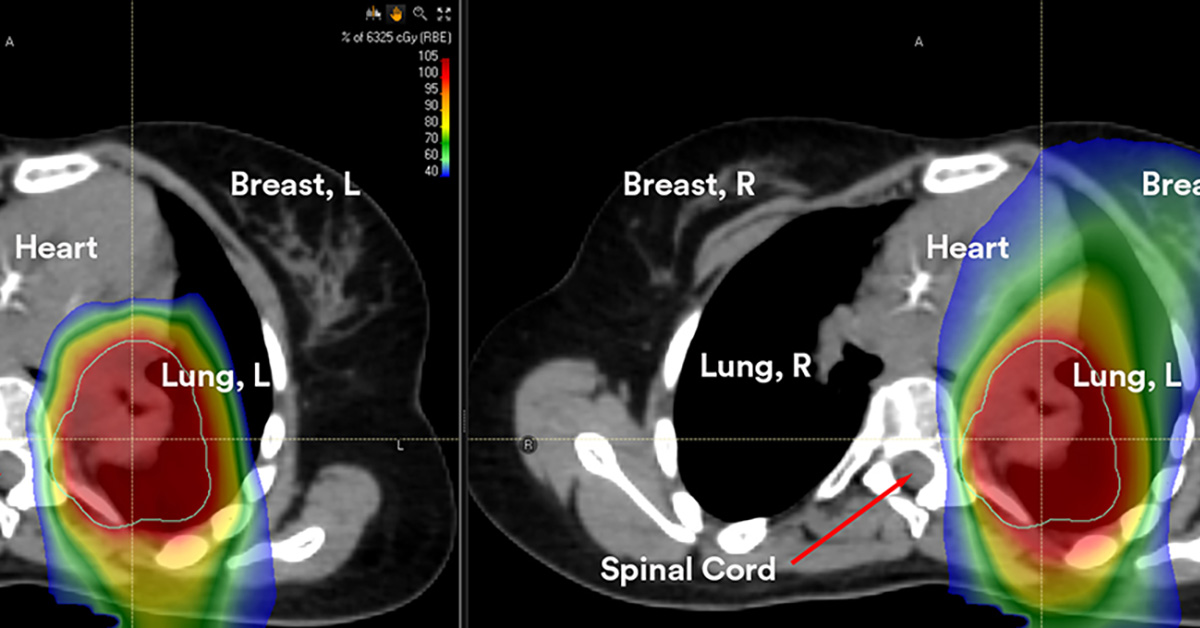 Seattle architect was shocked when diagnosed with a rare lung cancer at ...