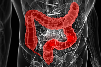 Bulk it up: High-fiber laxatives linked to lower colorectal cancer risk ...