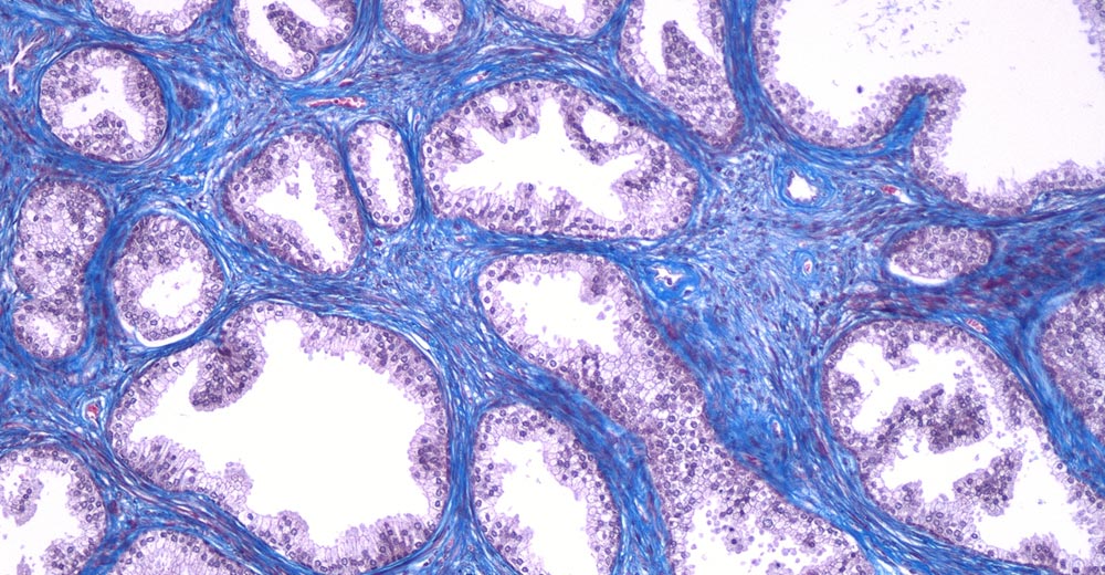 What’s new in prostate cancer? 5 things to watch | Fred Hutchinson ...