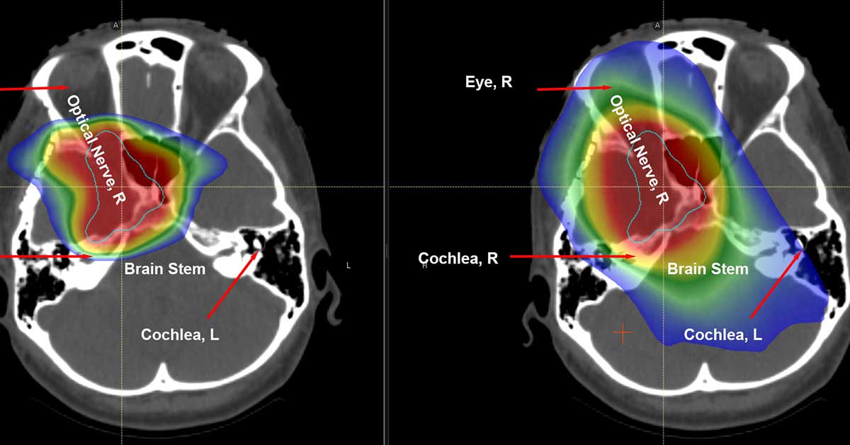 Brain Tumor Radiation Therapy