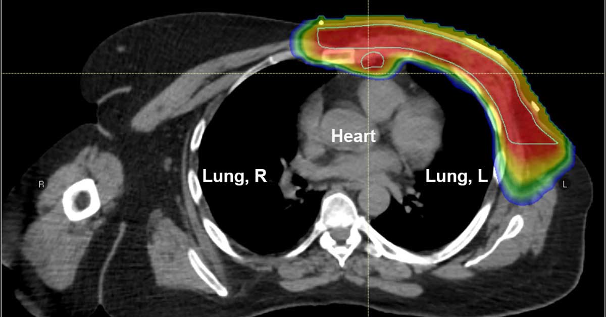 Proton Therapy for Breast Cancer - Fred Hutch