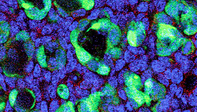 Cancers | Fred Hutchinson Cancer Center