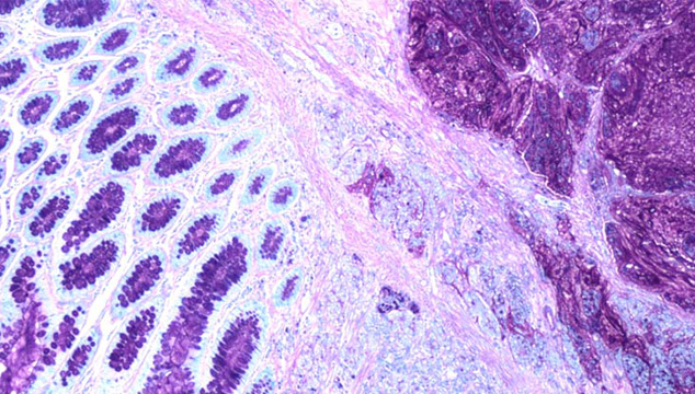 Cancers | Fred Hutchinson Cancer Center