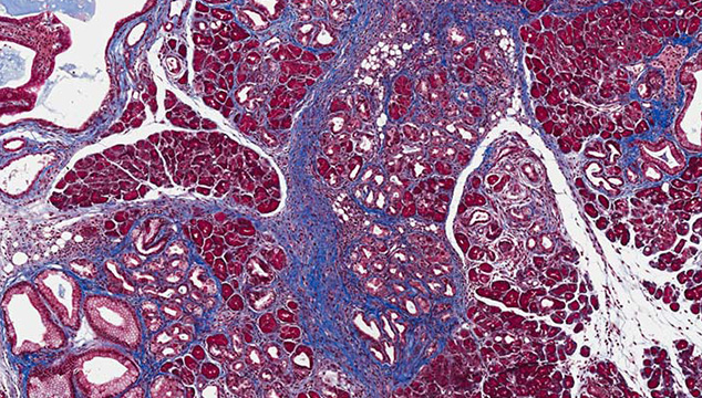 Cancers - Fred Hutch