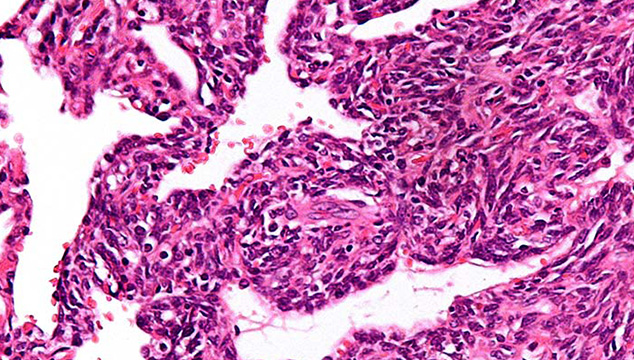 Cancers | Fred Hutchinson Cancer Center