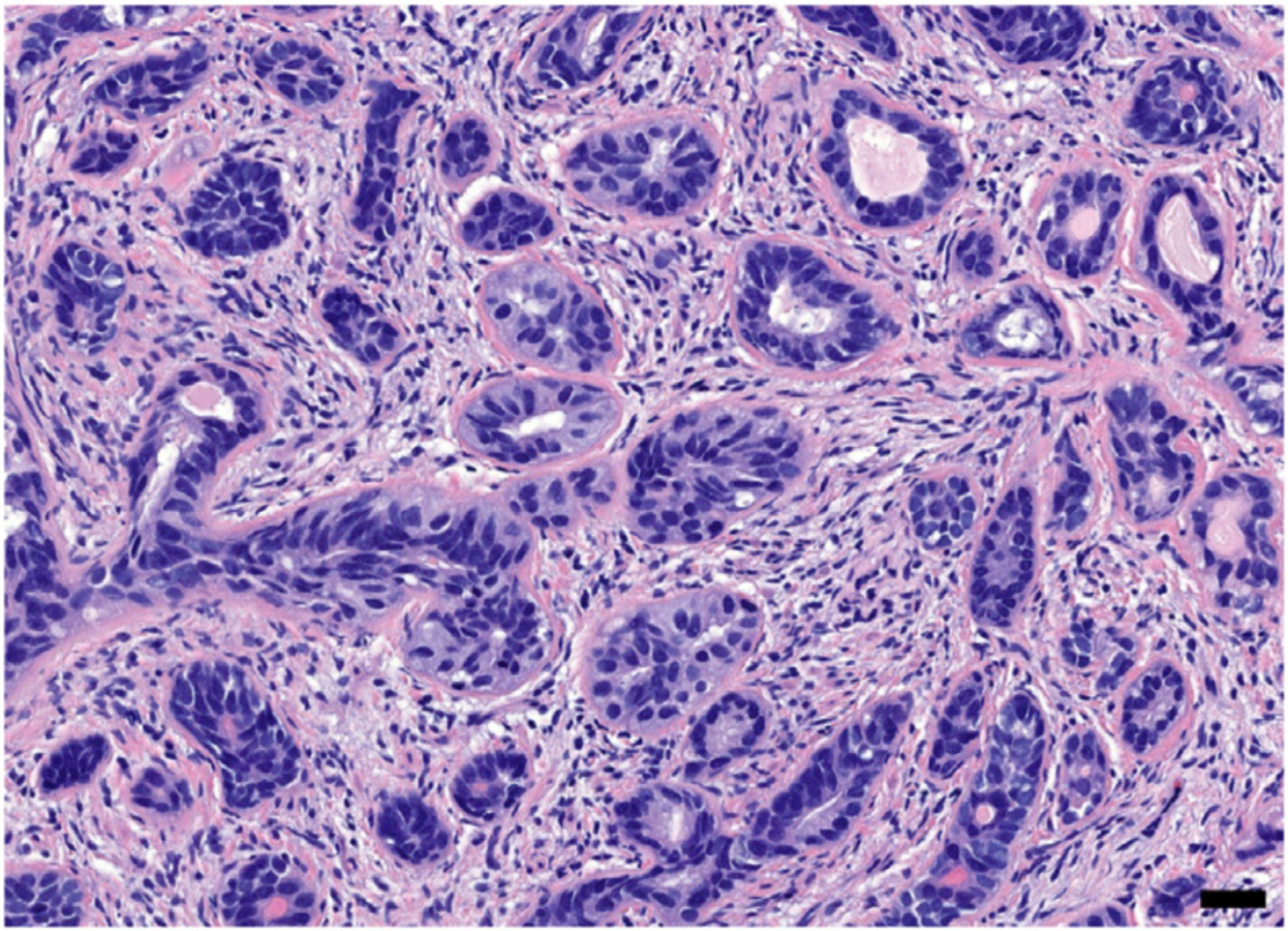 Prostate Cancer Histology Metastatic Prostate Adenocarcinoma To The