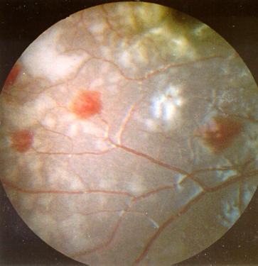 Eyes are the window to the soul (and malaria in the brain) - Fred Hutch