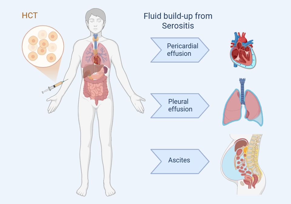 Going beneath the skin: A closer look at serositis in cGVHD | Fred ...