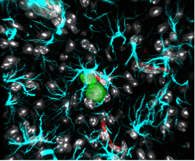Brain Cancer Cells Under Microscope