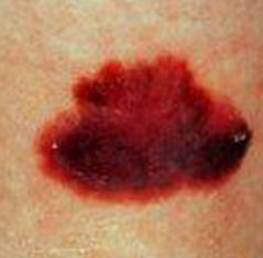 Pre Cancer Skin Spots