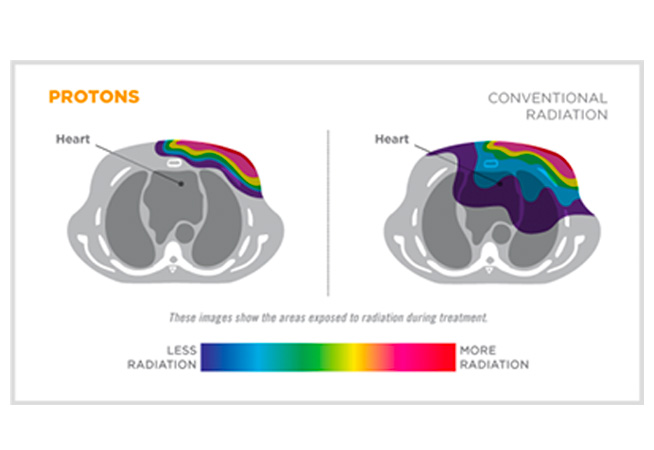 Breast cancer treatments and heart health: New information on the ...