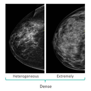 New law gives women more insight into their breast density | Fred ...