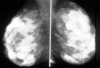 HRT doubles breast density - Fred Hutch