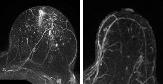 ‘True risk’ of breast cancer: MRI could more precisely pinpoint chances ...