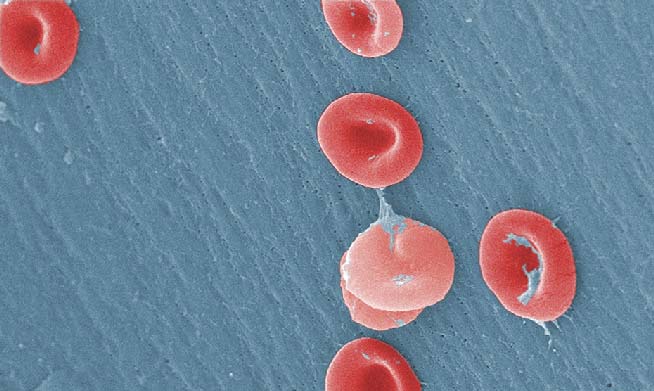 A look at emerging sickle cell disease therapies - Fred Hutch