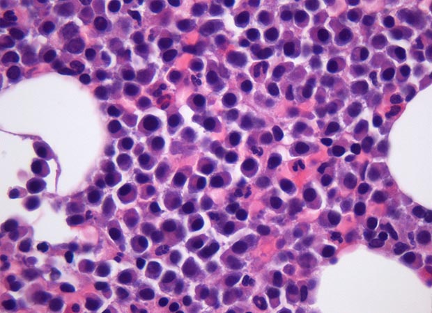 New approach could make bone marrow transplantation safer, stronger ...