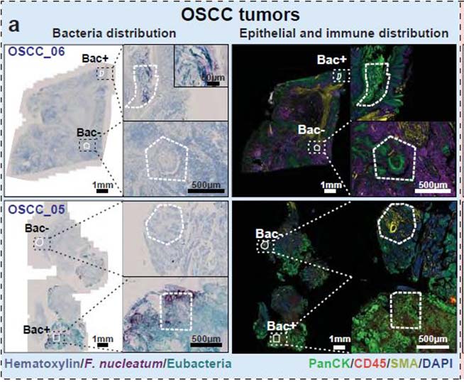 How bacteria give cancer a helping hand | Fred Hutchinson Cancer Center