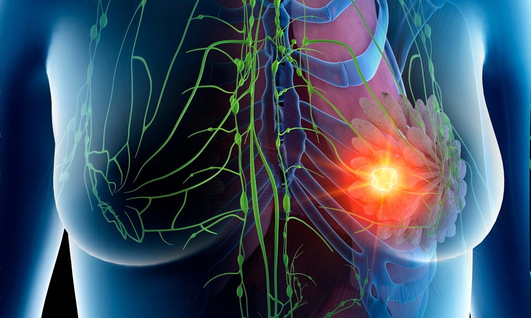 Breast cancer screening guidelines change — again - Fred Hutch