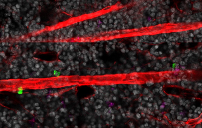 disseminated malignancy