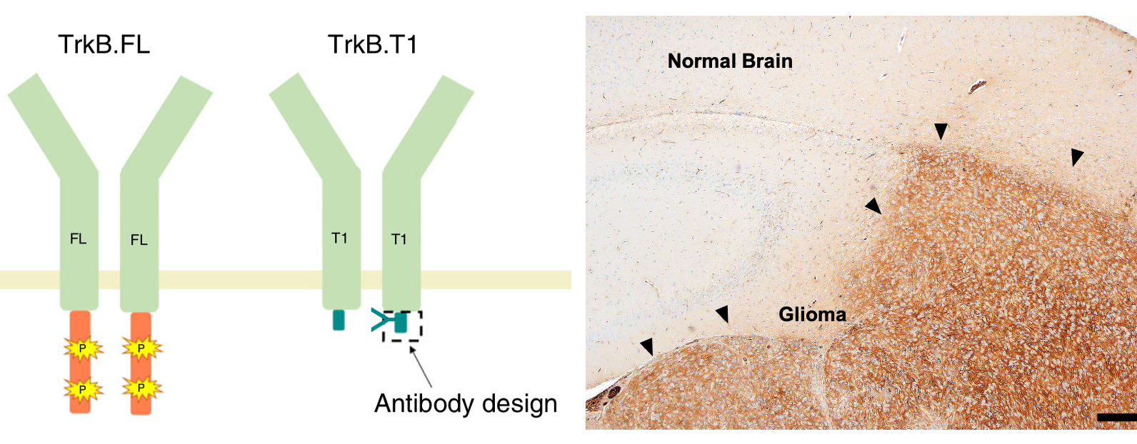 The NTRK2 splice variant TrkB.T1 plays a vital role in human glioma ...