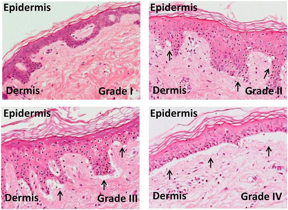 Sirolimus reduces incidence of graft-versus-host-disease in mismatched ...