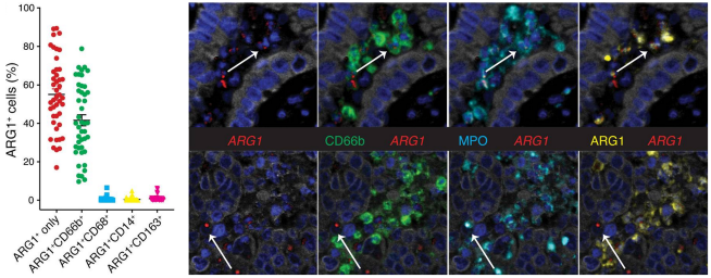 Neutrophils disguise tumors by synthesizing and secreting arginase ...