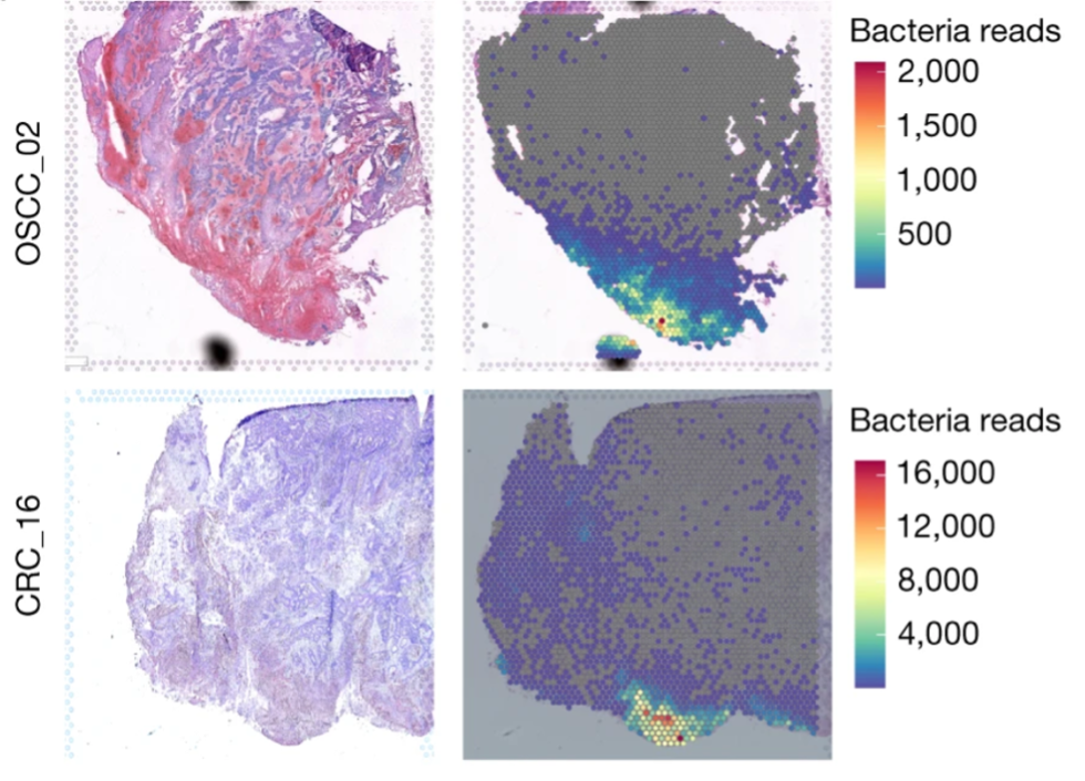 The ins and outs of the tumor microbiome | Fred Hutchinson Cancer Center