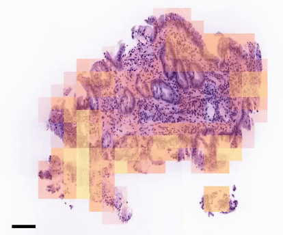 AI rides shotgun in the quest for better cancer diagnostics | Fred ...