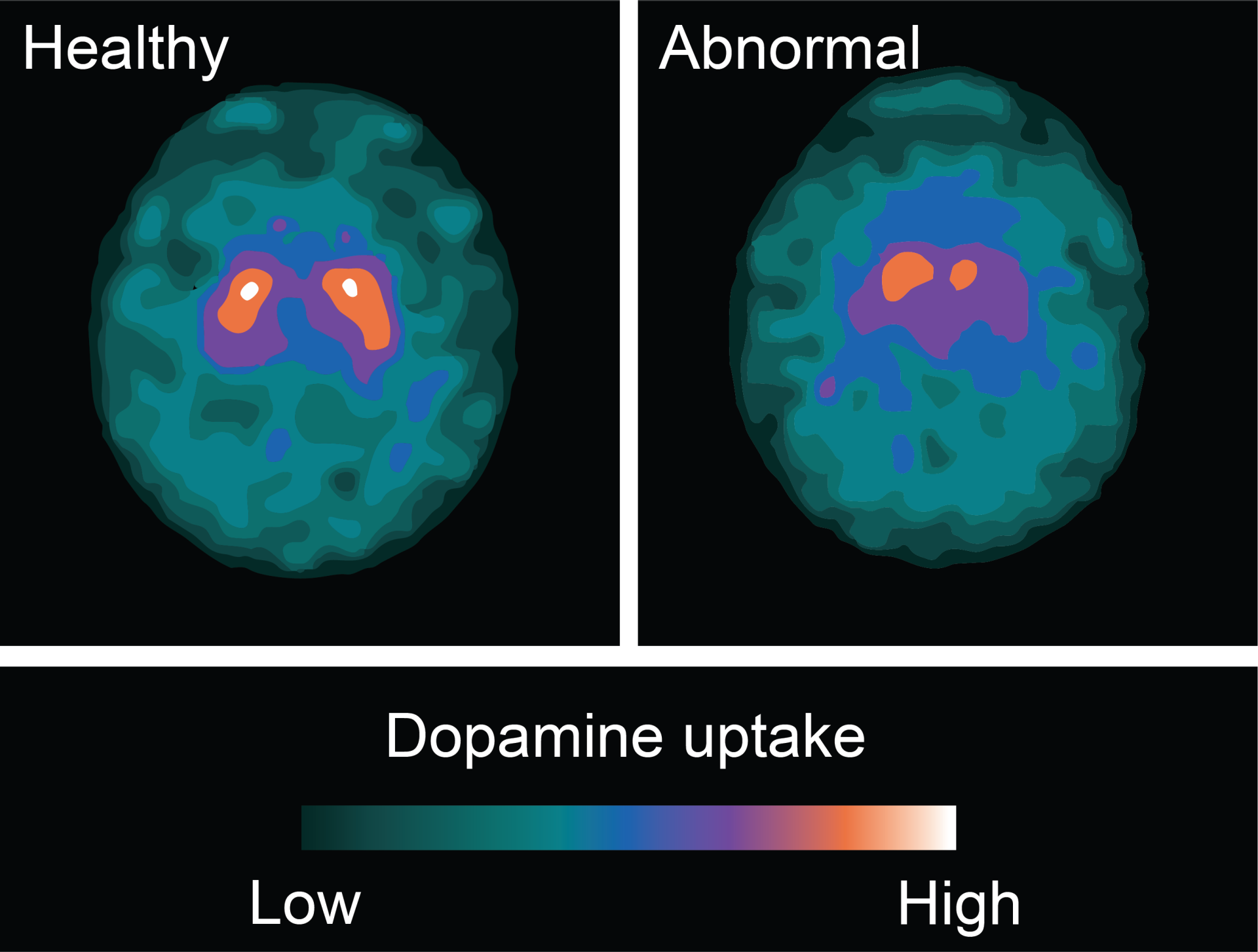 Understanding Parkinsonism after CAR T therapy - Fred Hutch