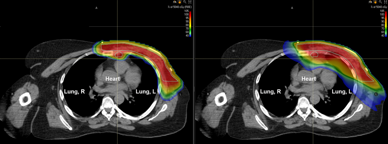 Proton Therapy for Breast Cancer - Fred Hutch
