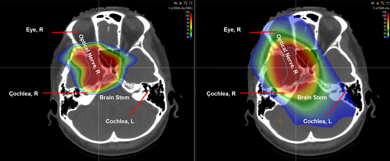 What Is Proton Therapy? | Fred Hutchinson Cancer Center