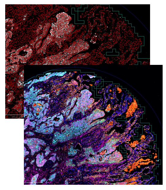 Translational Pathology | Fred Hutchinson Cancer Center