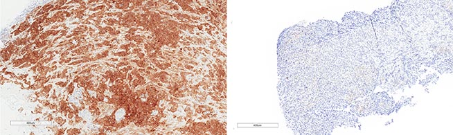 Preclinical Modeling Case Study: PDX Models of Bladder Cancer | Fred ...